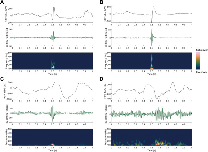 Pathological and Physiological High-frequency Oscillations on Electroencephalography in Patients ...