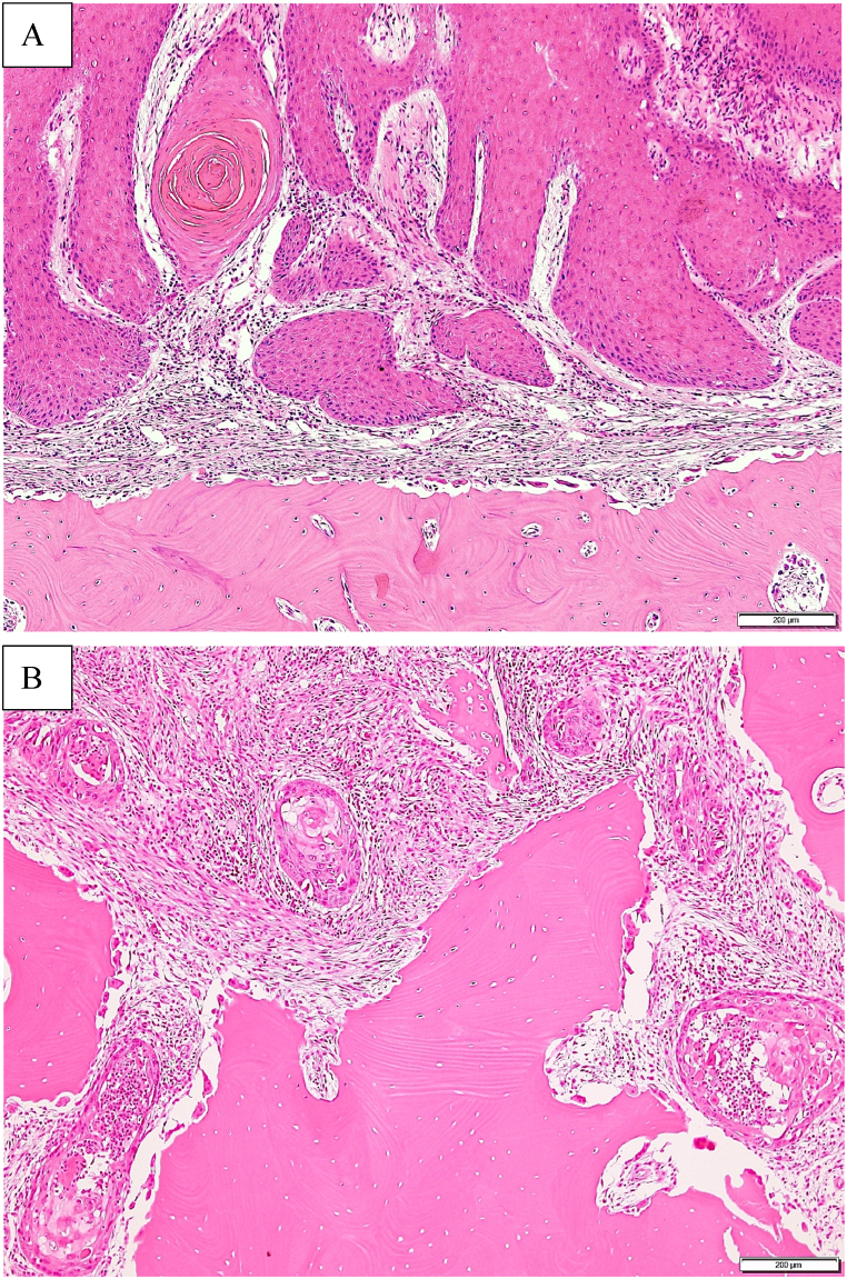 Clinicopathological analysis of 134 patients with squamous cell carcinoma of the mandibular ...
