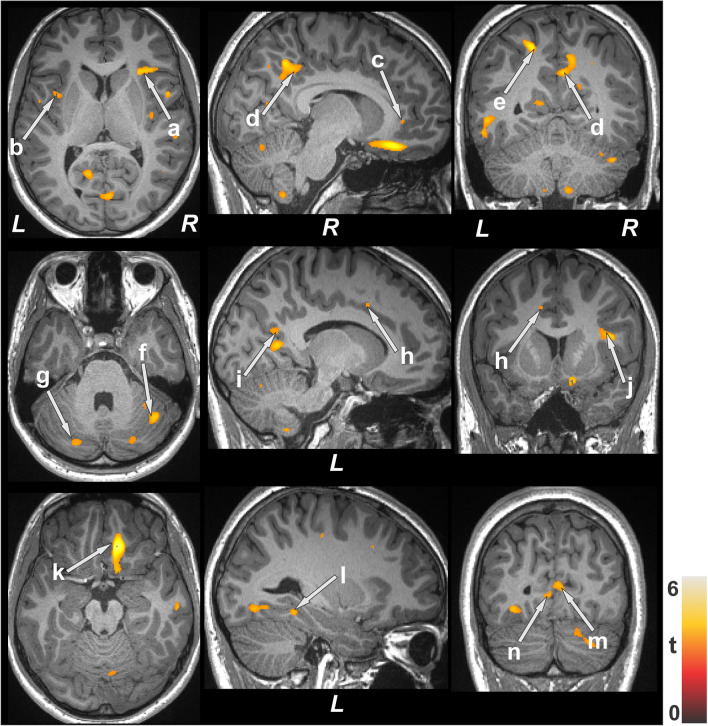 Microstructural brain tissue changes contribute to cognitive and mood deficits in adults with ...