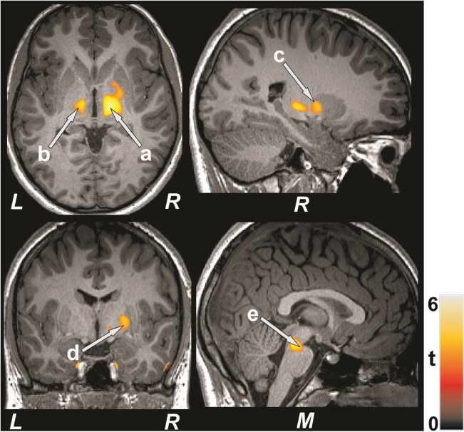 Microstructural brain tissue changes contribute to cognitive and mood deficits in adults with ...