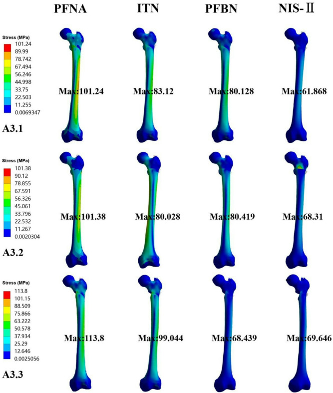Biomechanical evaluation of the new intramedullary system II for treating reverse obliquity ...