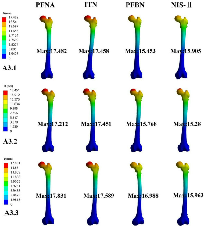 Biomechanical evaluation of the new intramedullary system II for treating reverse obliquity ...