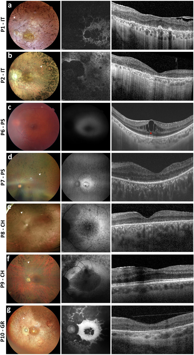 Variants in the AGBL5 gene are responsible for autosomal recessive Retinitis pigmentosa with ...