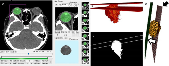 Measurement of proptosis using computed tomography based three-dimensional reconstruction ...