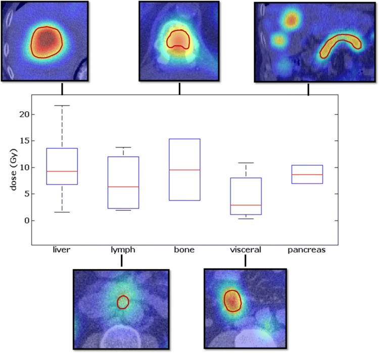 Three-dimensional Monte Carlo-based voxel-wise tumor dosimetry in patients with neuroendocrine ...