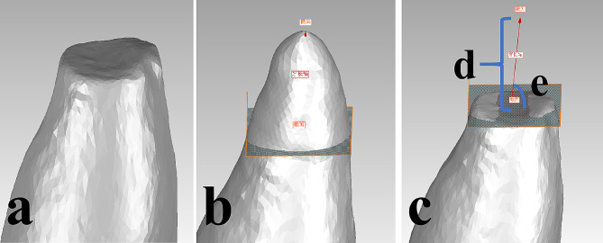 Accuracy and efficiency of dynamic navigated root-end resection in endodontic surgery: a pilot ...