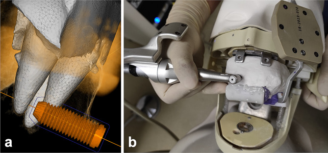 Accuracy and efficiency of dynamic navigated root-end resection in endodontic surgery: a pilot ...