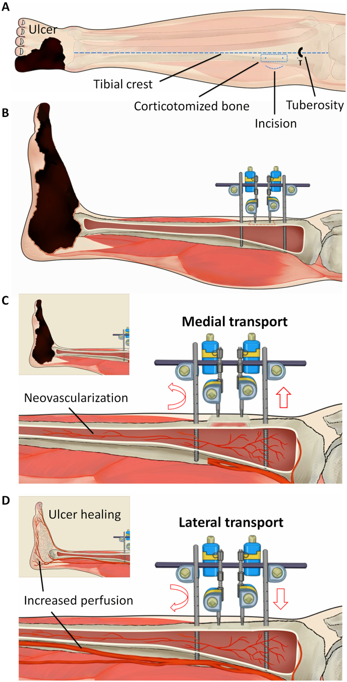 Effect of tibial cortex transverse transport in patients with recalcitrant diabetic foot ulcers ...