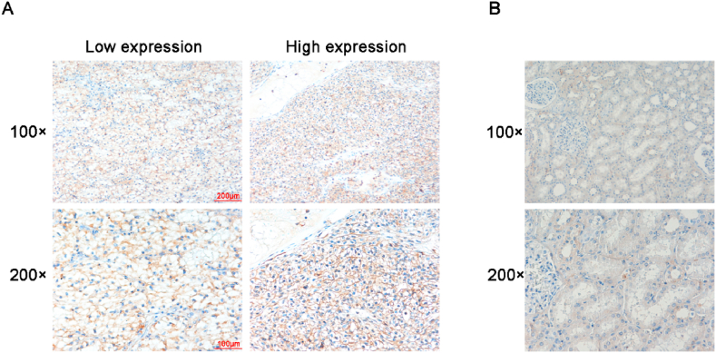 C-type lectin 2D (CLEC2D) is upregulated in clear cell renal cell carcinoma (ccRCC) tissues and ...