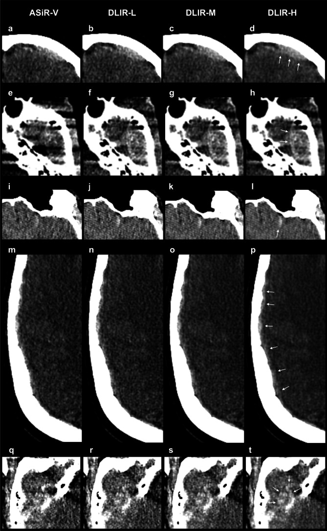 Deep learning versus iterative image reconstruction algorithm for head ...