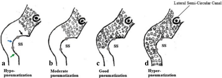 An inter-observer assessment of mastoid pneumatization and degree classification using sigmoid ...