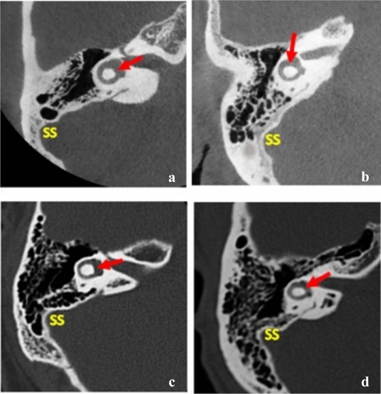 An inter-observer assessment of mastoid pneumatization and degree classification using sigmoid ...
