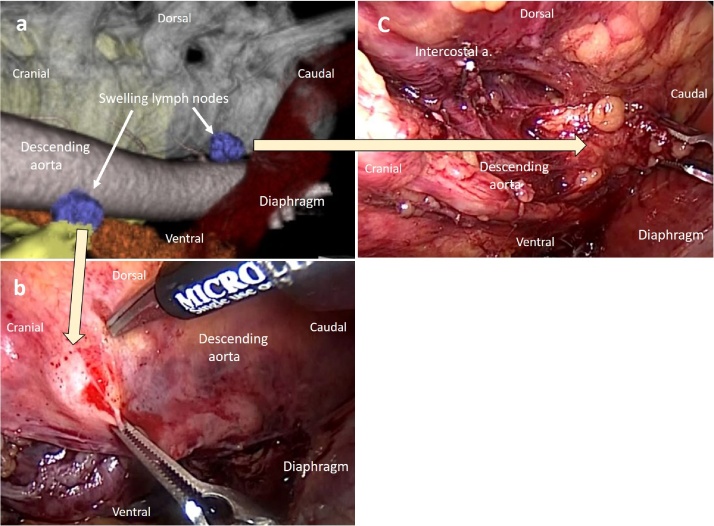 Bilateral approach for thoracoscopic esophagectomy with lymph node dissection in the dorsal area ...