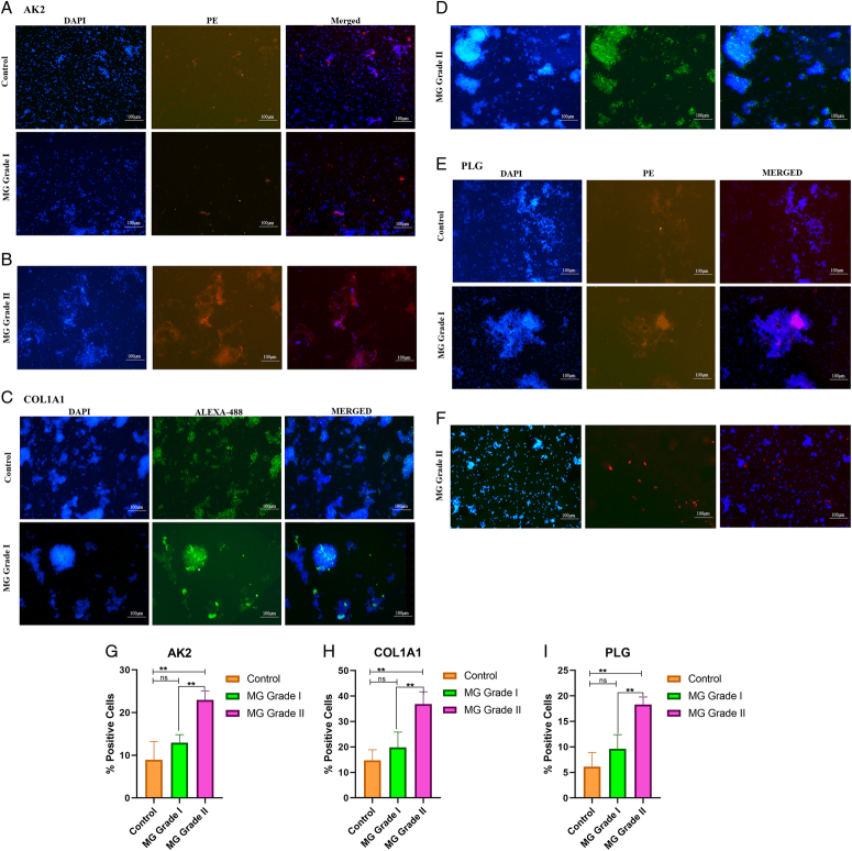 Quantitative tissue analysis reveals AK2, COL1A1, and PLG protein signatures: targeted ...