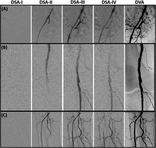 Radiation exposure reduction in peripheral interventions using digital ...