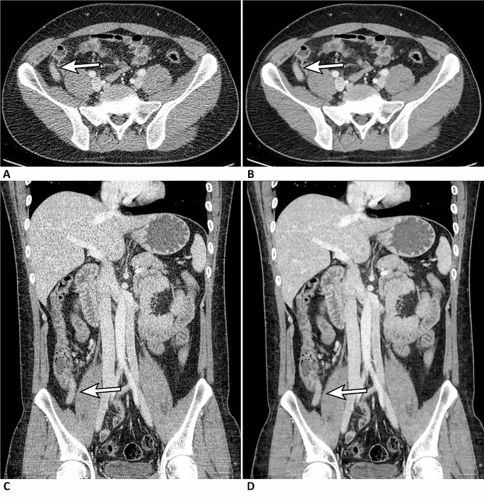 Diagnostic performance and image quality of an image-based denoising algorithm applied to ...