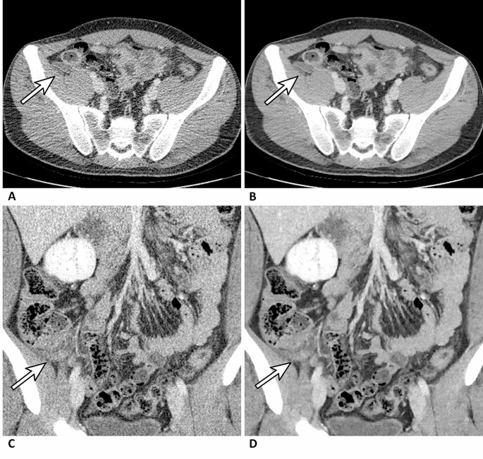 Diagnostic performance and image quality of an image-based denoising algorithm applied to ...