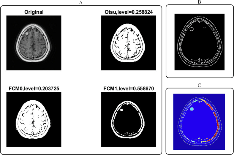Automated segmentation of meningioma from contrast-enhanced T1-weighted MRI images in a case ...