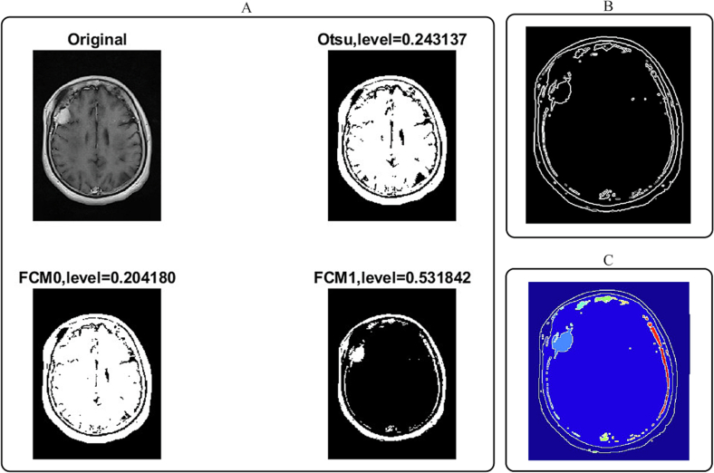 Automated segmentation of meningioma from contrast-enhanced T1-weighted MRI images in a case ...