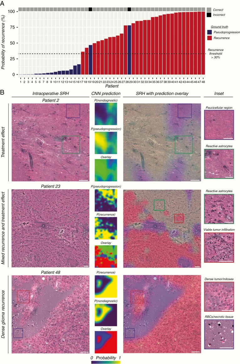 Rapid, label-free detection of diffuse glioma recurrence using intraoperative stimulated Raman ...