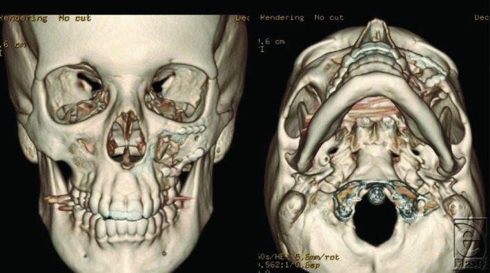 Zygomaticomaxillary Complex Fracture Pmc