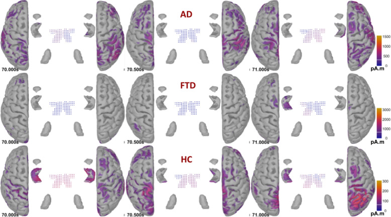 Deep learning-based classification of dementia using image representation of subcortical signals ...