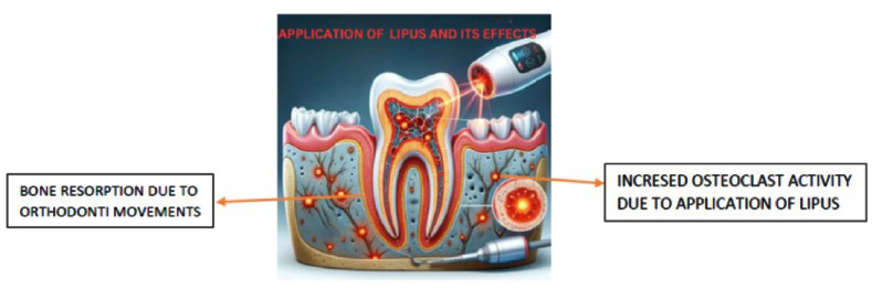 Attenuation of orthodontically induced inflammatory root resorption by using low-intensity ...