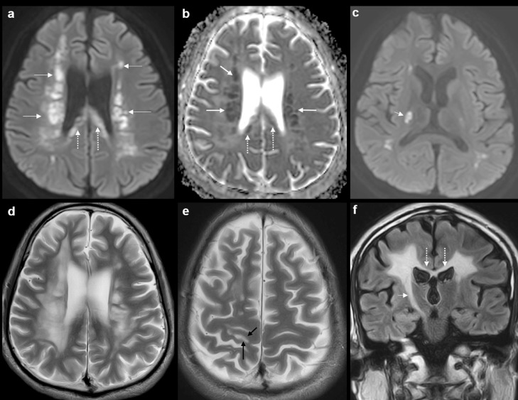 Adult-onset diffuse leukoencephalopathy with axonal spheroids and pigmented glia presenting with ...
