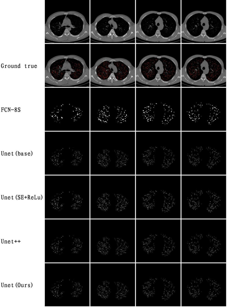 Application of improved Unet network in the recognition and segmentation of lung CT images in ...
