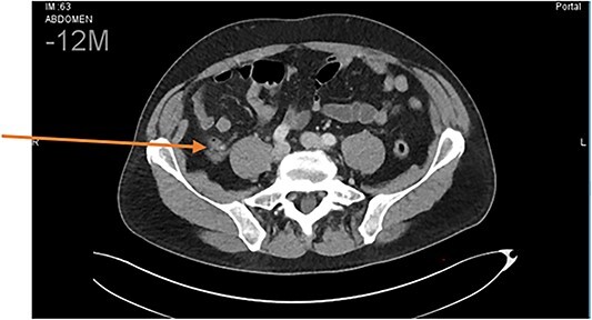 Vermiform appendix torsion complicated by postoperative venous pylephlebitis: a case report and ...