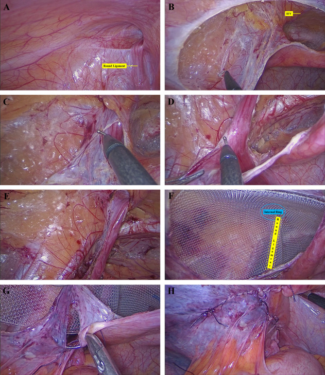 Laparoscopic transabdominal preperitoneal repair for female patients with groin hernias - PMC