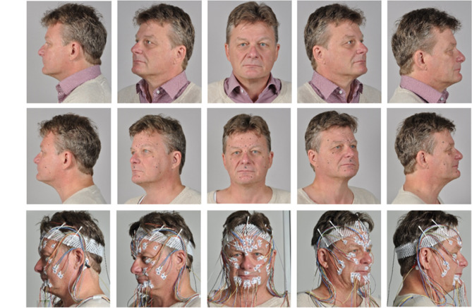 Synchronous surface electromyography as objective method to evaluate the outcome of a ...