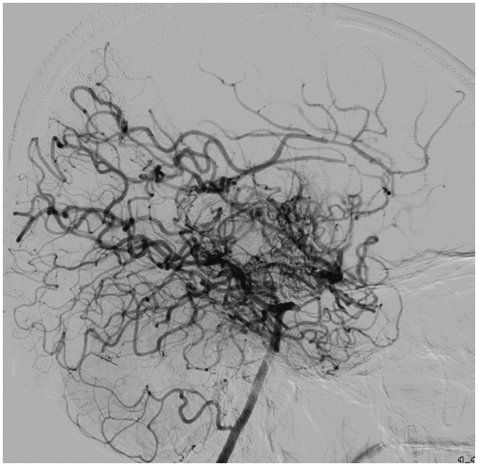 Signs In Neuroradiology A Pictorial Review Pmc