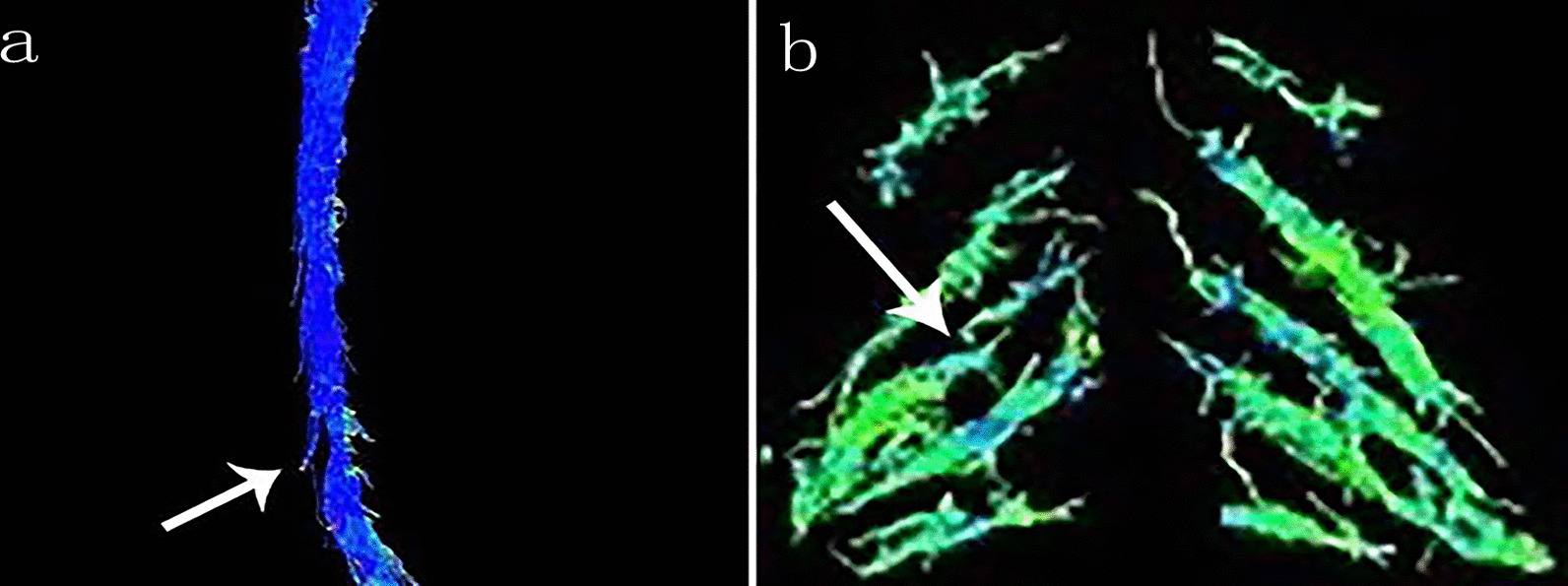 Changes and clinical correlation of diffusion tensor imaging parameters of compressed spinal ...
