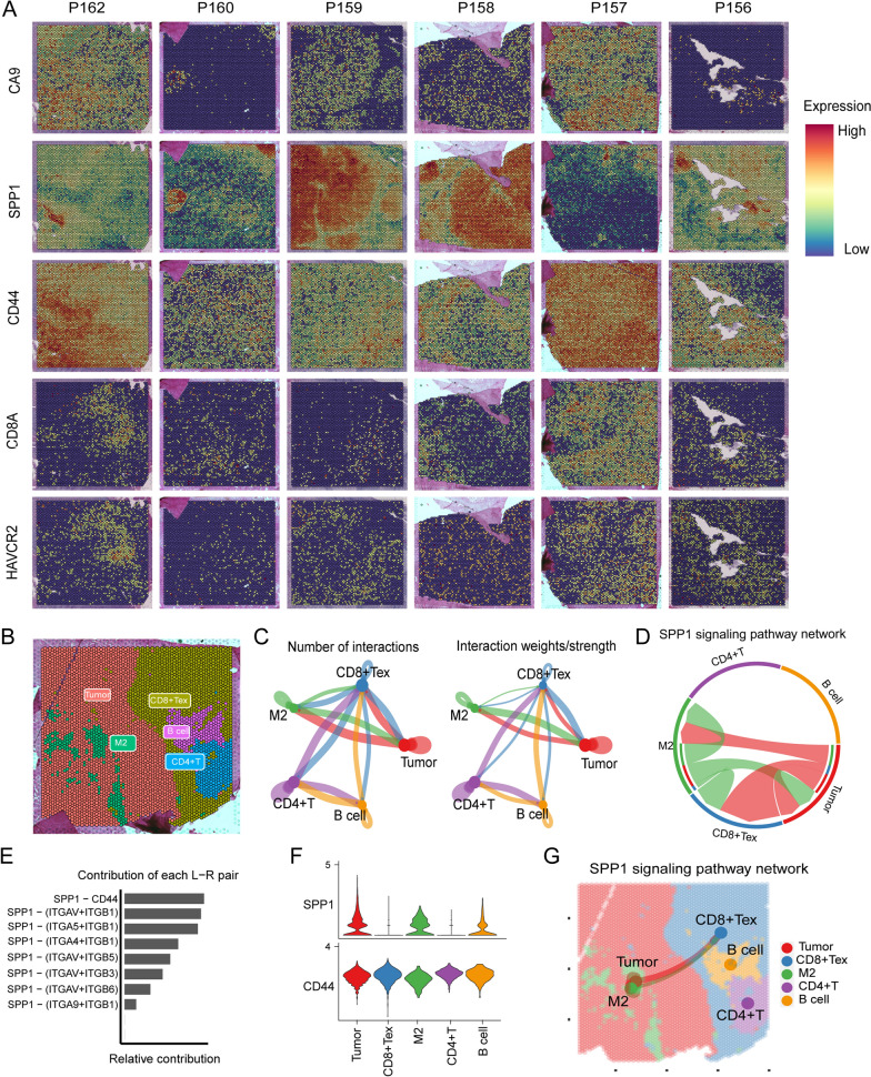 Single-cell and spatial transcriptomics reveal SPP1-CD44 signaling drives primary resistance to ...