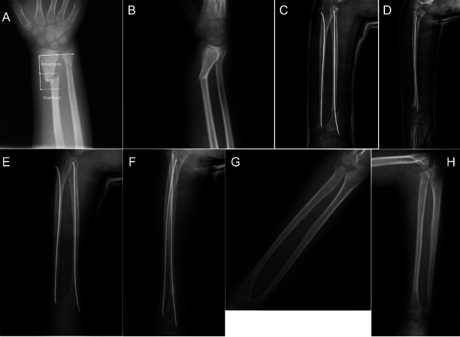 Elastic stable intramedullary nailing versus Kirschner wire in the treatment of pediatric ...