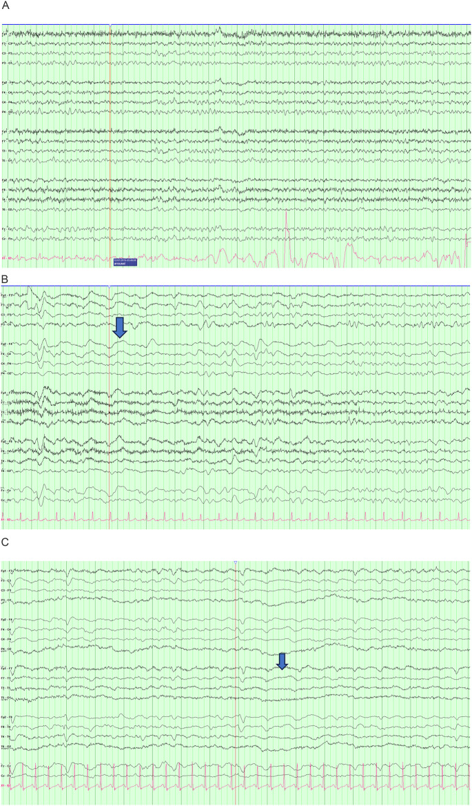 EEG features and synek scale indicate severity of neurotoxicity in adult patients treated with ...