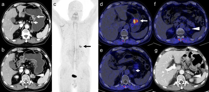 Impact of 68Ga-FAPI positron emission tomography/computed tomography on staging and tumor ...