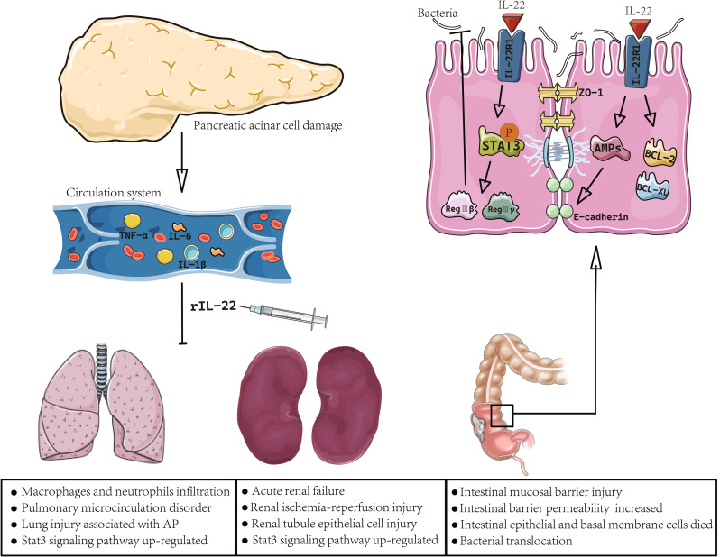 The role of Interleukin-22 in severe acute pancreatitis - PMC