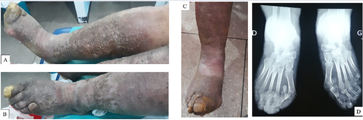 Elephantiasis Nostras Verrucosa Of The Lower Limb A Case Report And