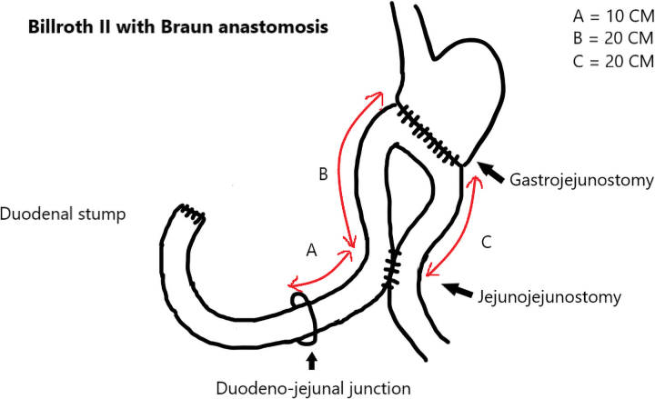 Severe acute pancreatitis in the early postoperative period due to afferent loop syndrome ...