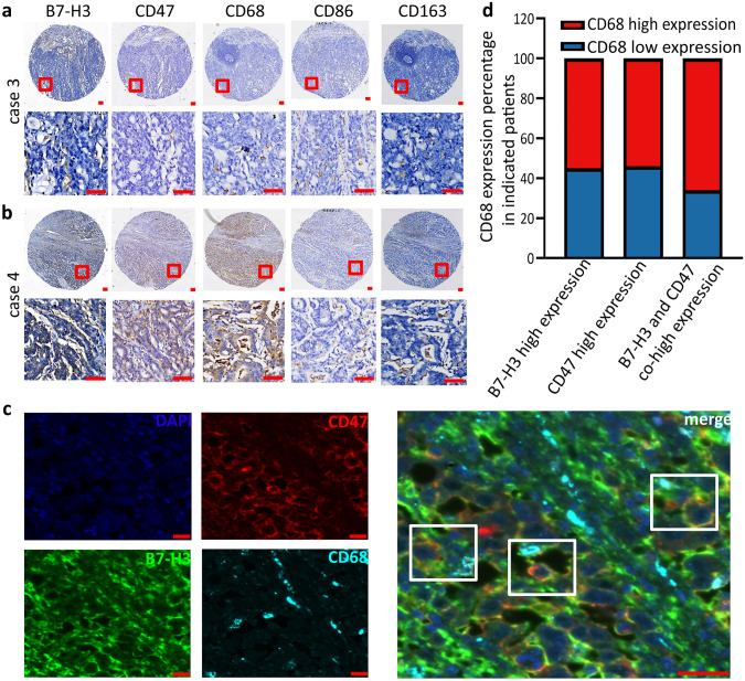 B7-H3 and CD47 co-expression in gastric cancer is a predictor of poor ...