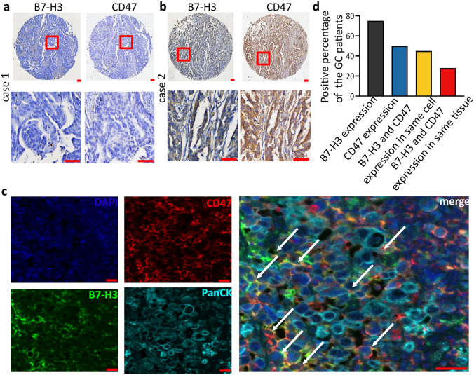 B7-H3 and CD47 co-expression in gastric cancer is a predictor of poor ...