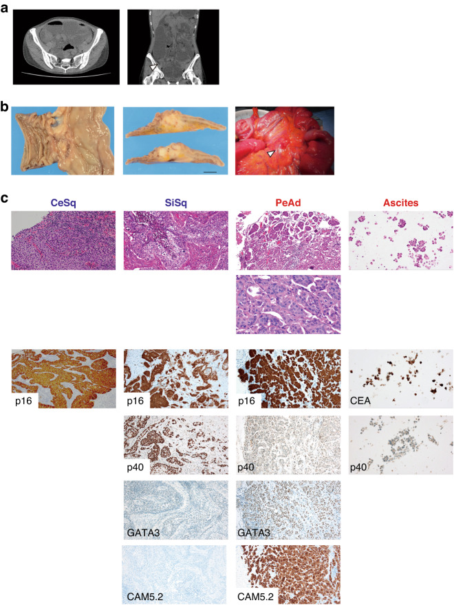 Transdifferentiation of cervical squamous cell carcinoma with ERBB2 amplification to ...