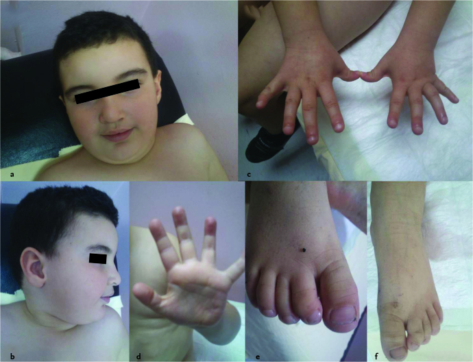 A Rare Sex Chromosome Aneuploidy 48xxyy Syndrome Pmc