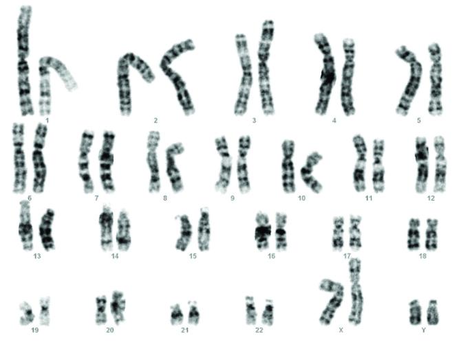 A Rare Sex Chromosome Aneuploidy 48xxyy Syndrome Pmc
