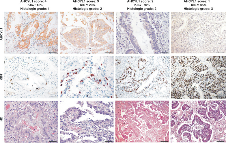S-adenosylhomocysteine hydrolase-like protein 1 (AHCYL1) inhibits lung cancer tumorigenesis by ...