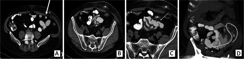 Jejunal perforation secondary to blind insertion of peritoneal dialysis catheter: a case report ...
