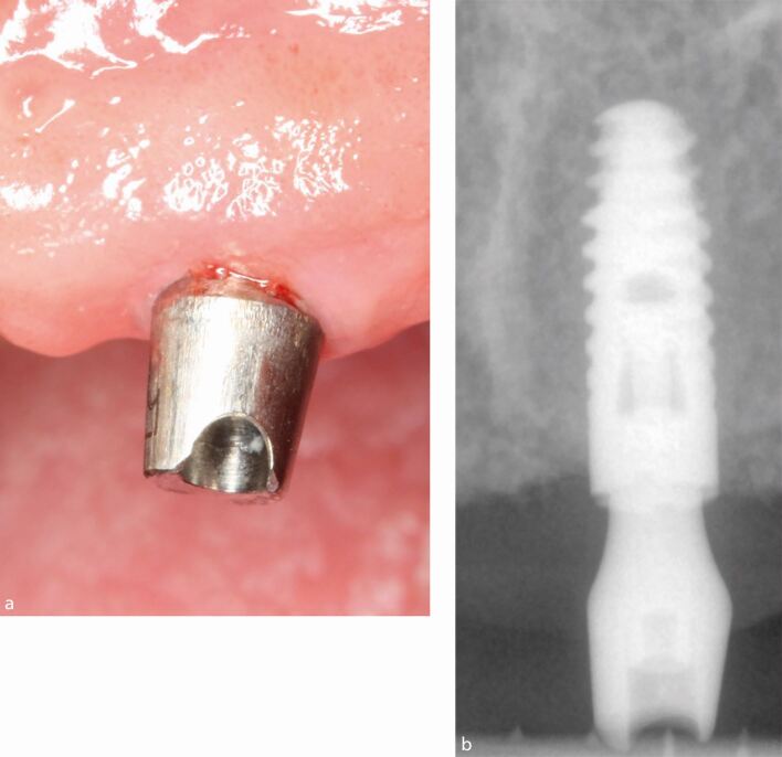 Peri-implant mucositis and peri-implantitis: key features and differences - PMC