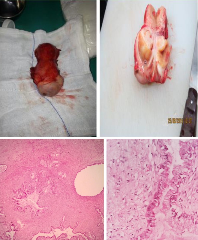 A Rare Case of Adenoma Malignum: Preparing for the Unforeseen - PMC